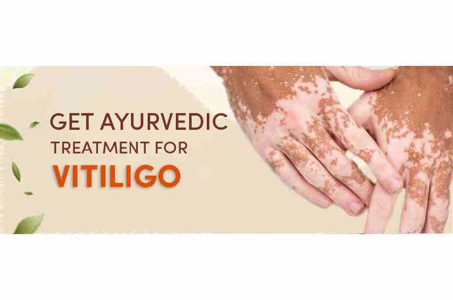 Get Ayurvedic Treatment For Vitiligo